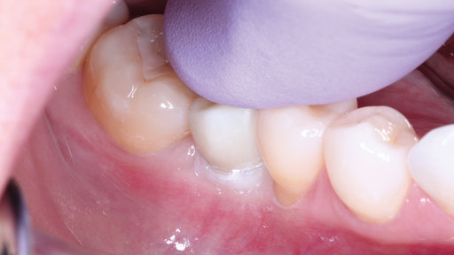 Clinical Consideration: An Alternative Technique to Eliminate Retained ...