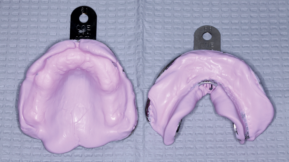 How to Fine-Tune Form and Function During Complete Denture Fabrication