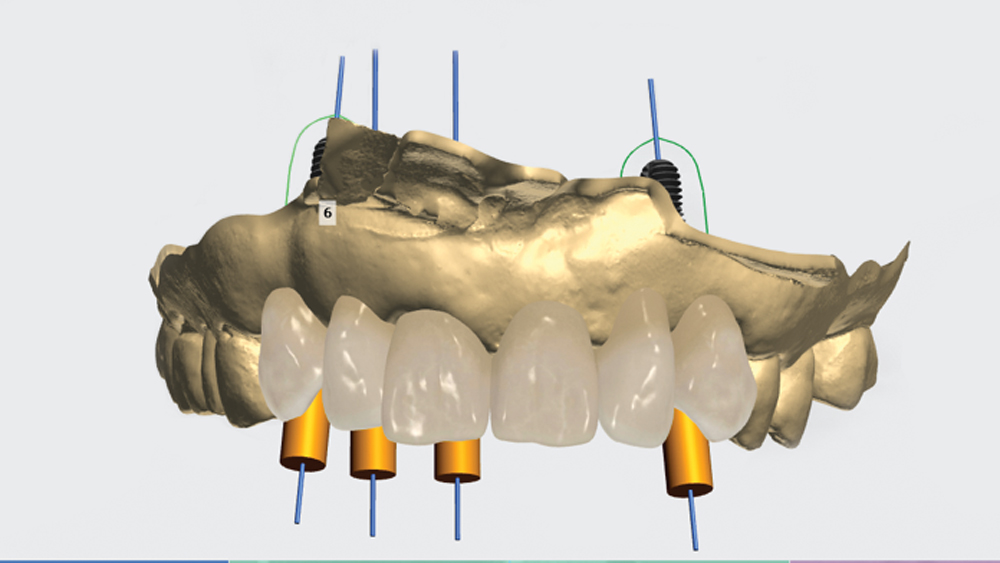 Utilizing Digital Dentistry and CAD/CAM Prosthetics to Optimize ...