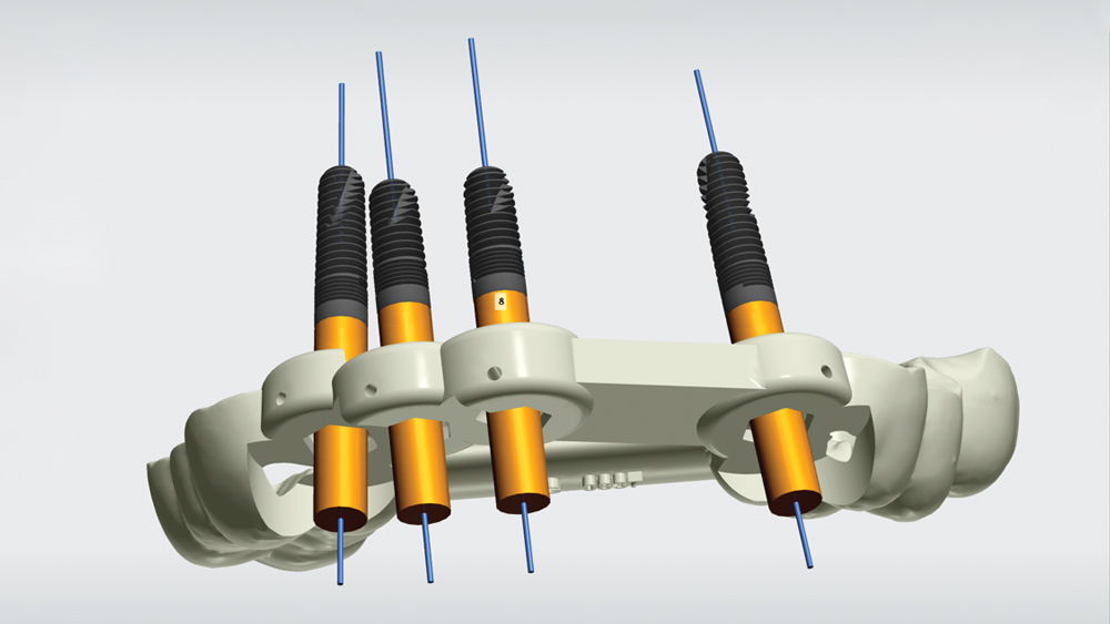 Utilizing Digital Dentistry and CAD/CAM Prosthetics to Optimize ...