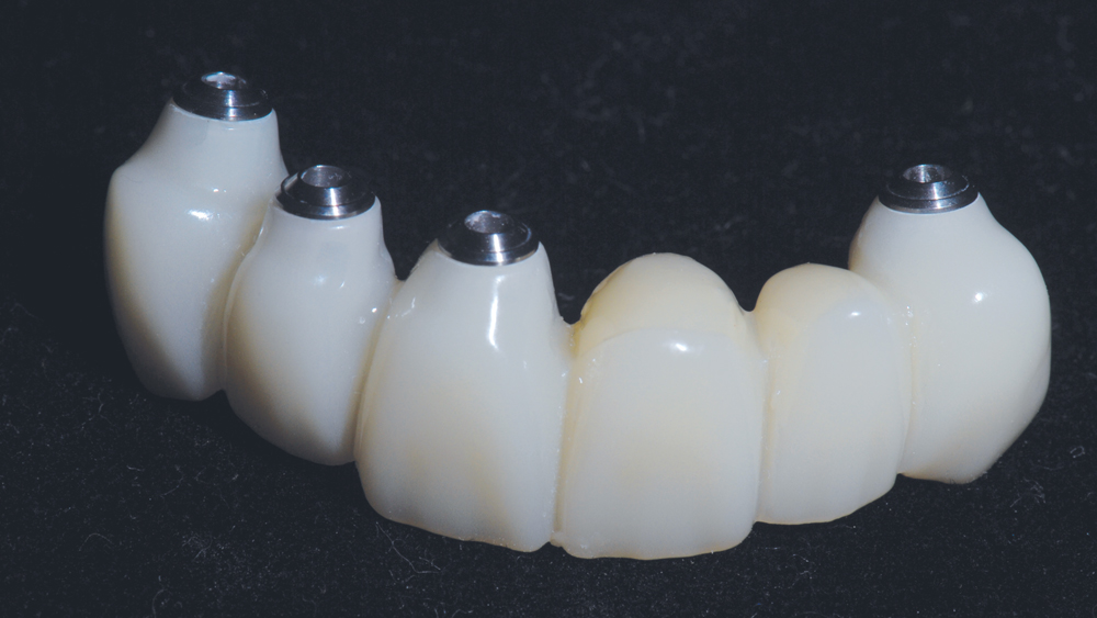 Utilizing Digital Dentistry and CAD/CAM Prosthetics to Optimize ...