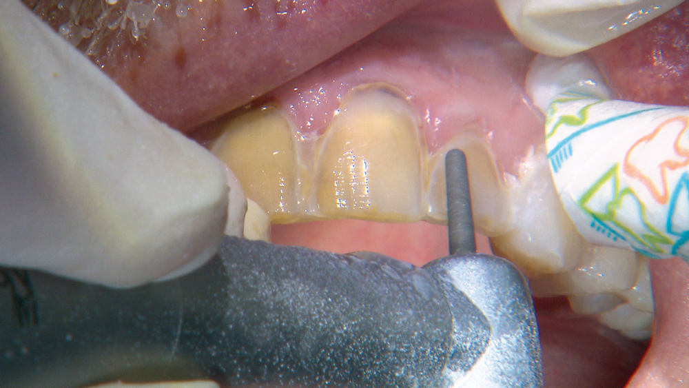 'Chairside Live' Case of the Week: Replacing Worn Direct Composite ...