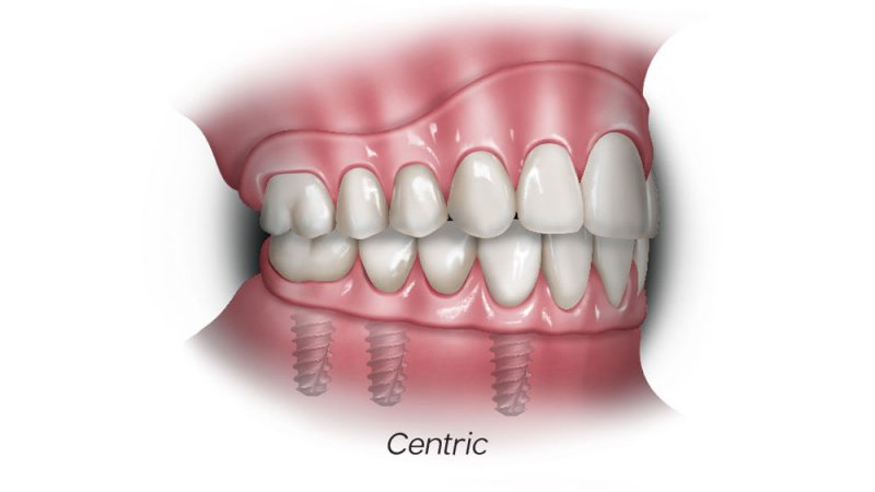 Principles of Implant Occlusion: Part 3 — Recommendations for Fixed ...