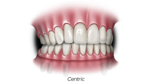 Principles of Implant Occlusion: Part 3 — Recommendations for Fixed ...