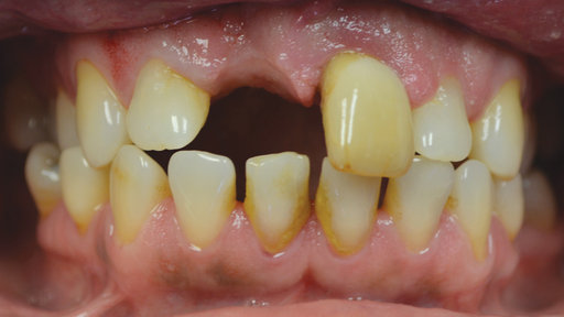 Osteotomes: Versatile Instruments in Your Implant Armamentarium