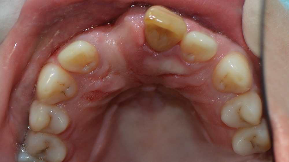 Osteotomes: Versatile Instruments in Your Implant Armamentarium