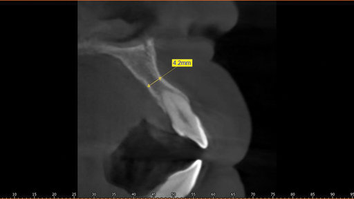 Osteotomes: Versatile Instruments in Your Implant Armamentarium