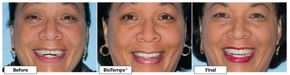 The Many Advantages of a Premade Custom Provisional