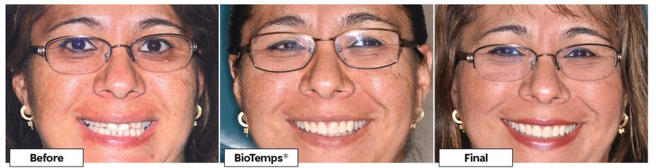 The Many Advantages of a Premade Custom Provisional