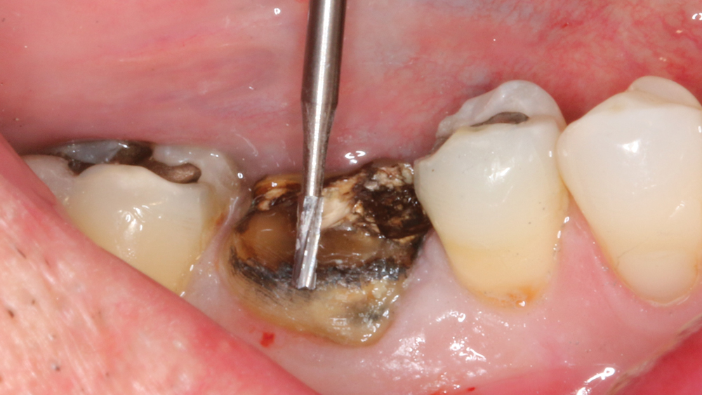 Bone Grafting: Essential Indications and Techniques in Implant Dentistry