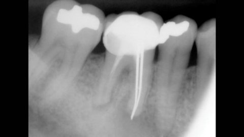 Bone Grafting: Essential Indications and Techniques in Implant Dentistry