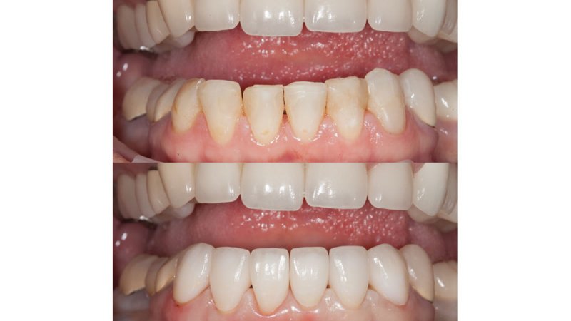 Rodolfo Castillo: The Unsung Hero of Obsidian® Lithium Silicate Ceramic