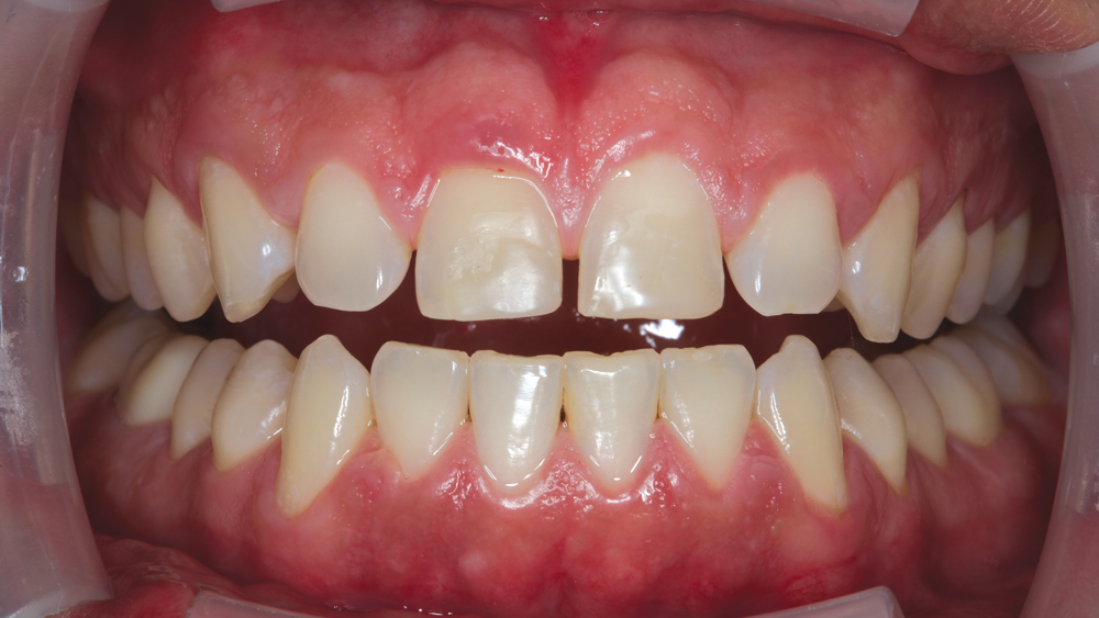 Confidence in Veneers: Choosing the Right Material to Eliminate Spaces ...