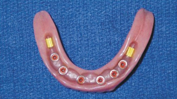 Principles of Implant Occlusion: Part 4 — Recommendations for Removable ...