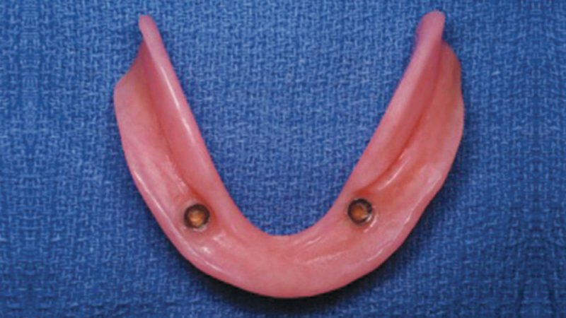 Principles of Implant Occlusion: Part 4 — Recommendations for Removable ...