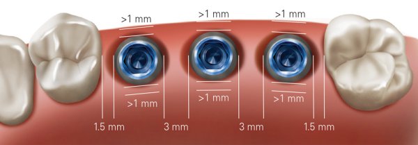 Implant Spacing and Selection in the Posterior