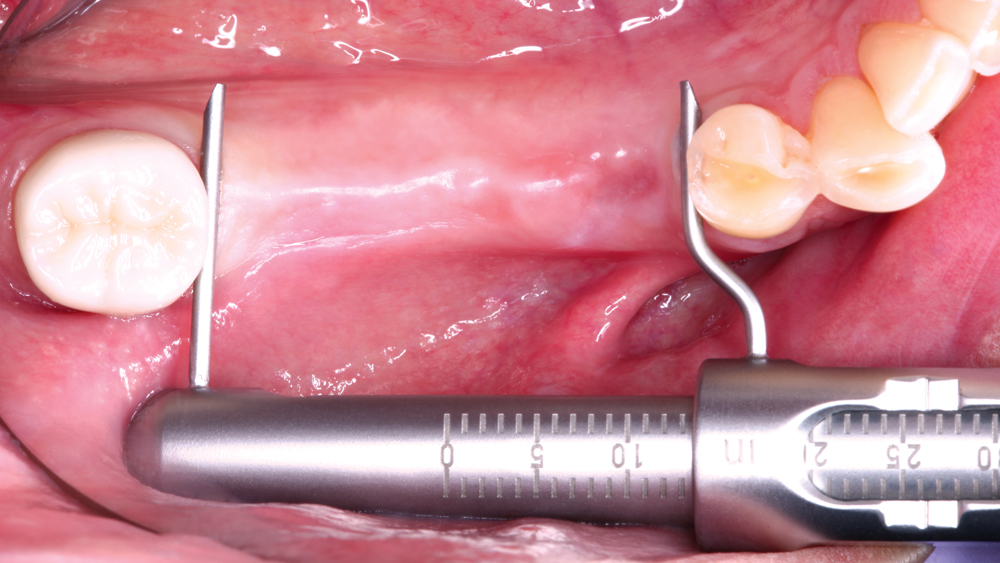 Implant Spacing and Selection in the Posterior