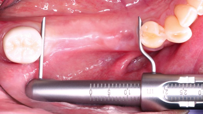 Implant Spacing and Selection in the Posterior