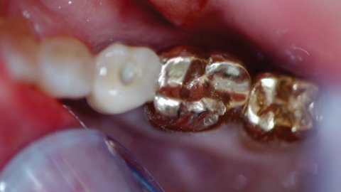 In-Office Milling vs. Lab Fabrication: Making Case Decisions