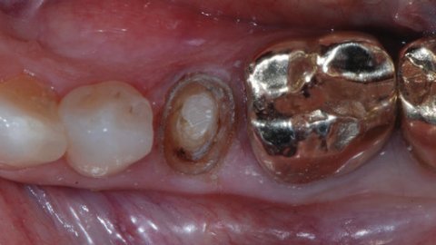 In-Office Milling vs. Lab Fabrication: Making Case Decisions