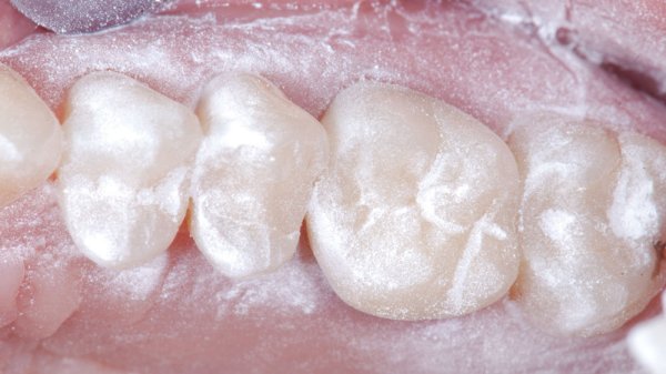 In-Office Milling vs. Lab Fabrication: Making Case Decisions