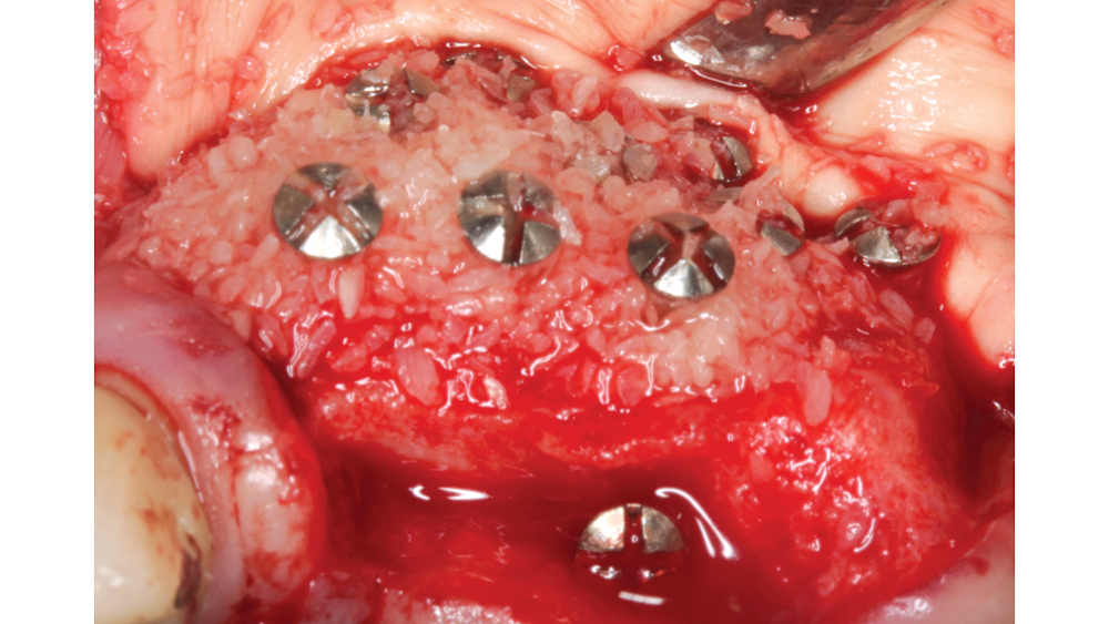 Bone Substitutes in Oral Implantology