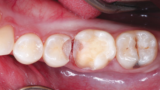 Q&A with Justin Chi, DDS, CDT: Milling In-Office Inlays and Onlays with ...