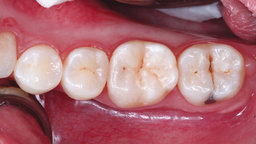 Q&A with Justin Chi, DDS, CDT: Milling In-Office Inlays and Onlays with ...