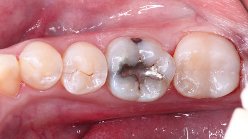 Q&A with Justin Chi, DDS, CDT: Milling In-Office Inlays and Onlays with ...