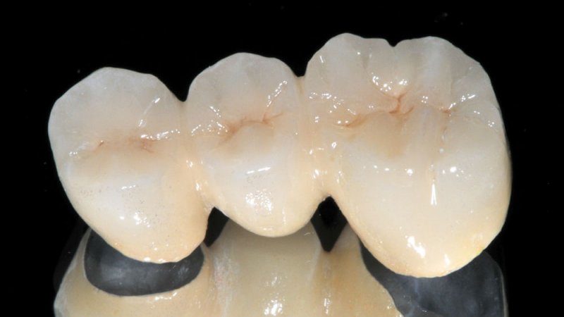 R&D Corner: Chipping Resistance: Traditional PFMs vs. Obsidian® Fused ...