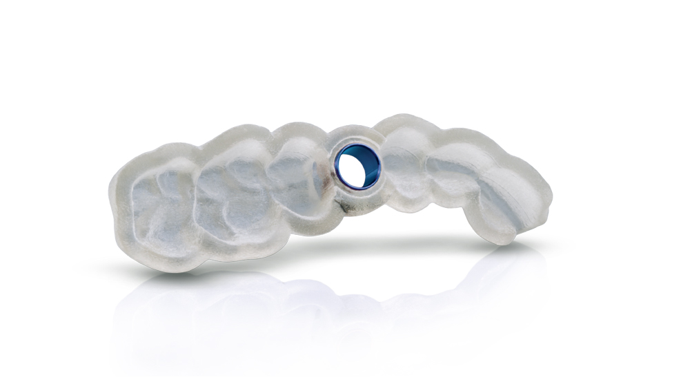 Clinical Benefits of Digitally Guided Implant Surgery
