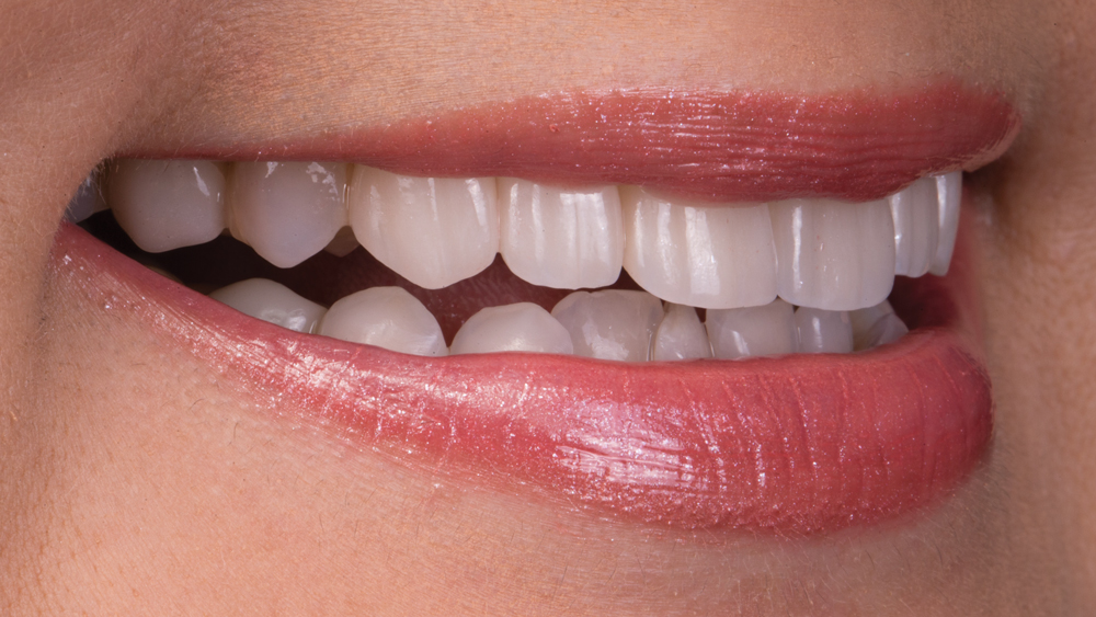 Product Spotlight: Veneer Materials