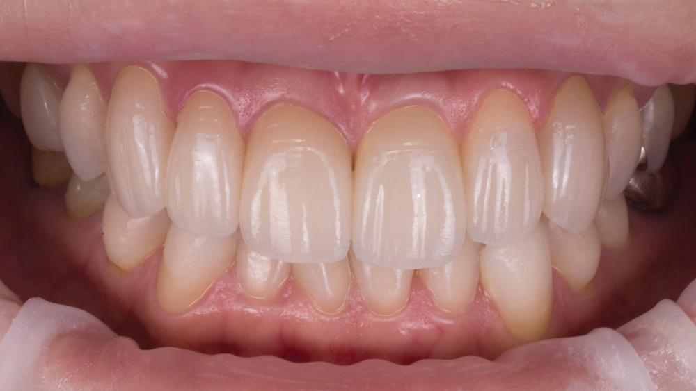 Product Spotlight: Veneer Materials