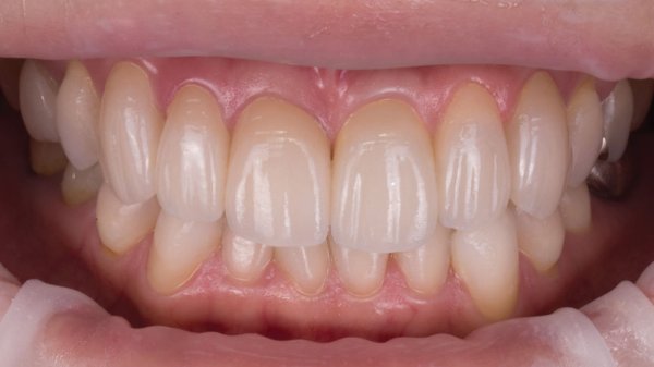 Product Spotlight: Veneer Materials