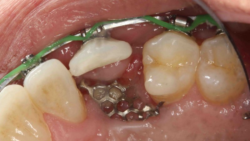 The Use of Barrier Membranes in Implant Dentistry