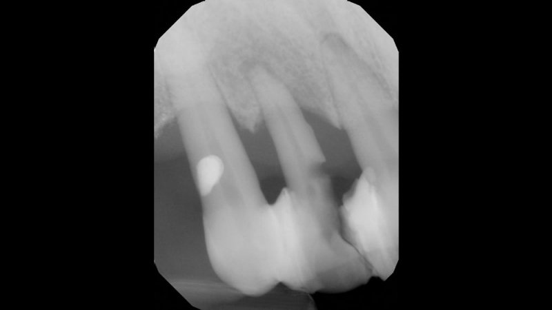 The Half-Arch Restoration: Solving a Challenging Problem with a Solid ...