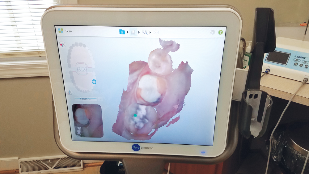 Single-Appointment Restorations Using the iTero Element® Scanner