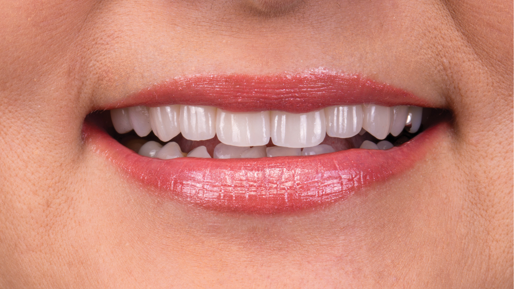 Veneer Prep School: Designing the Ideal Preparation