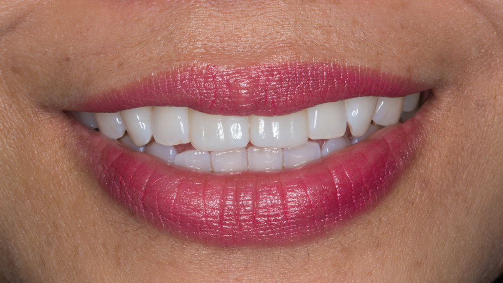 Veneer Prep School: Designing the Ideal Preparation