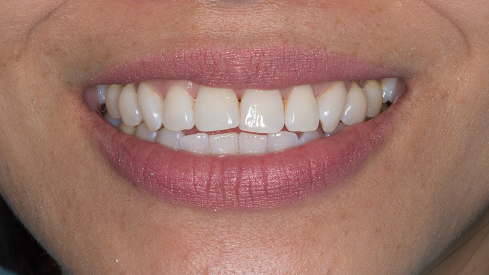 Veneer Prep School: Designing the Ideal Preparation