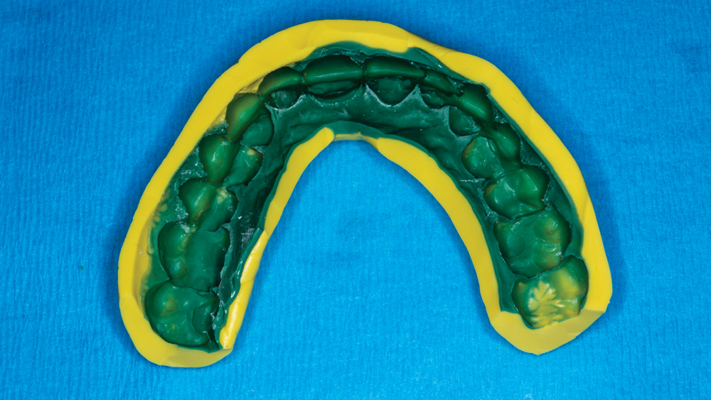 Veneer Prep School: Designing the Ideal Preparation