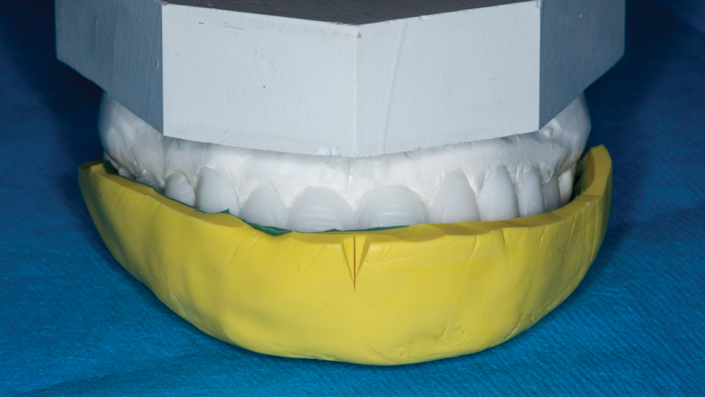 Veneer Prep School: Designing the Ideal Preparation