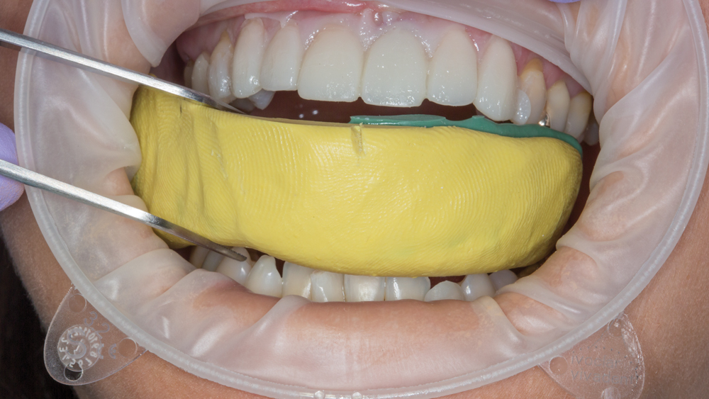 Veneer Prep School: Designing the Ideal Preparation