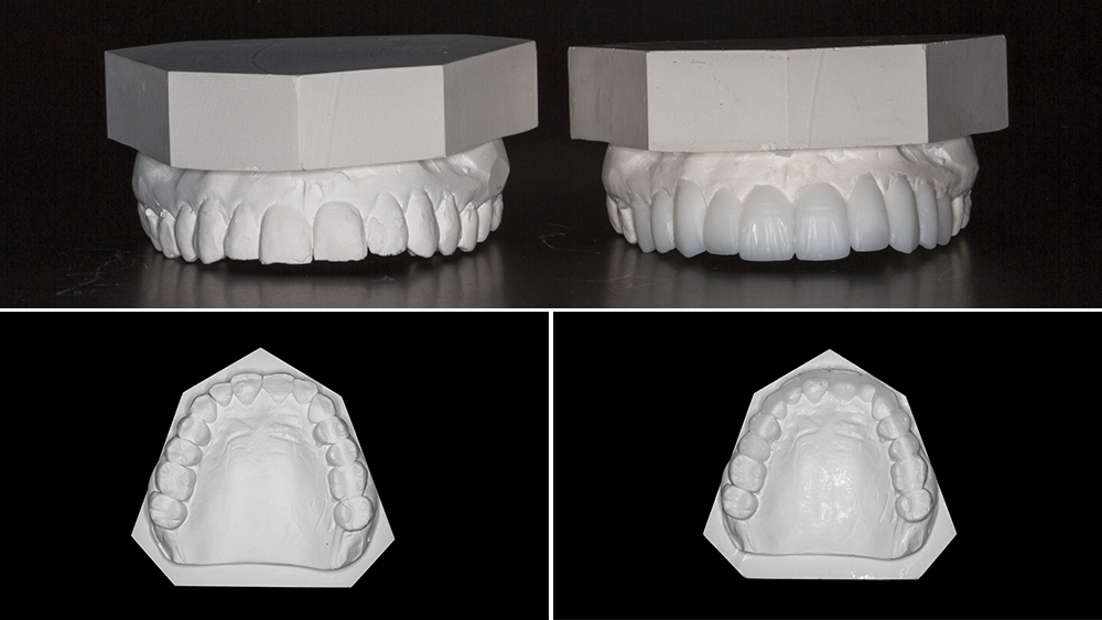 Veneer Prep School: Designing the Ideal Preparation