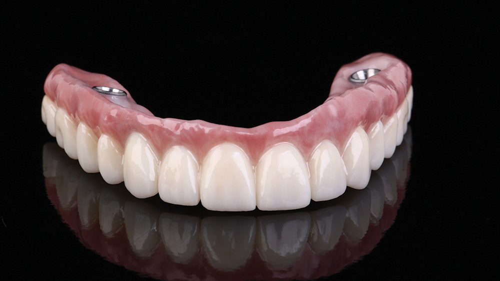 Full-Arch Implant Restorations: Improving Patients’ Lives Over the ...