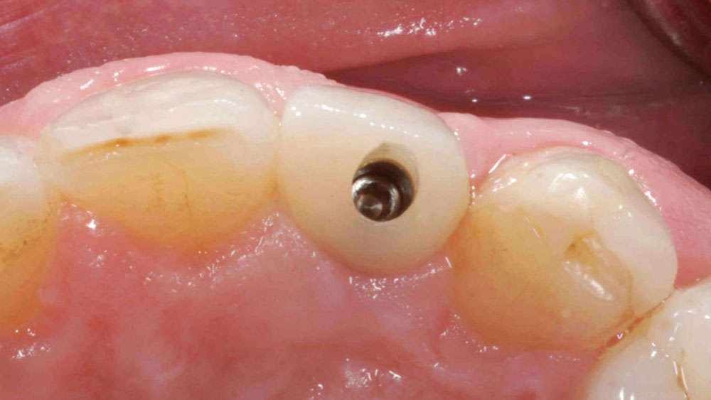 Getting Started with Anterior Implant Placement