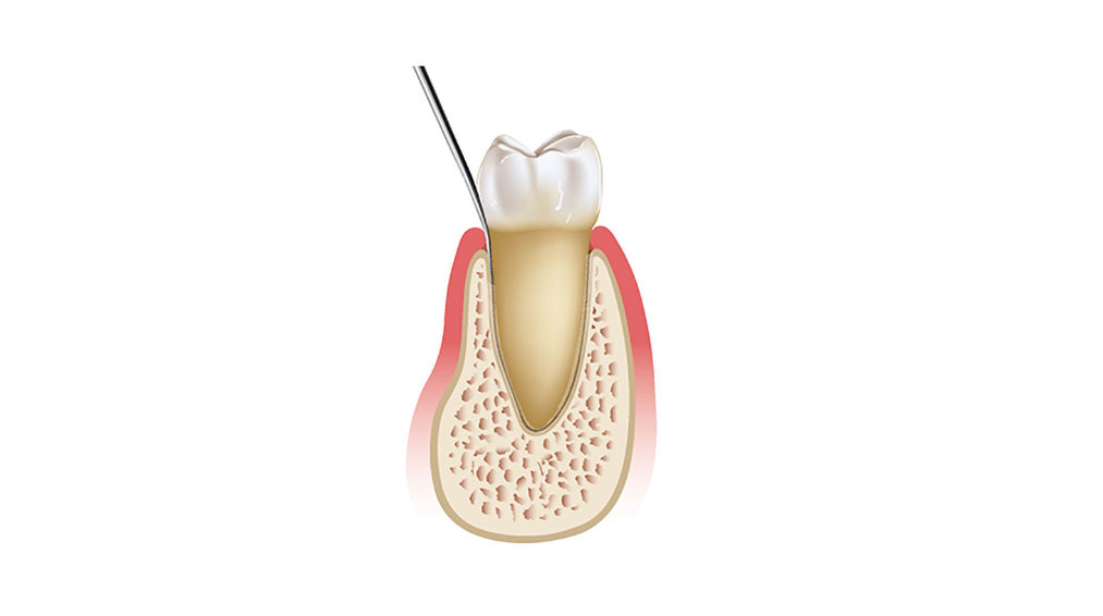 Extraction and Socket Grafting: Part 1 — Atraumatic Extraction