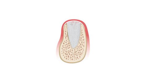 Extraction and Socket Grafting: Part 1 — Atraumatic Extraction