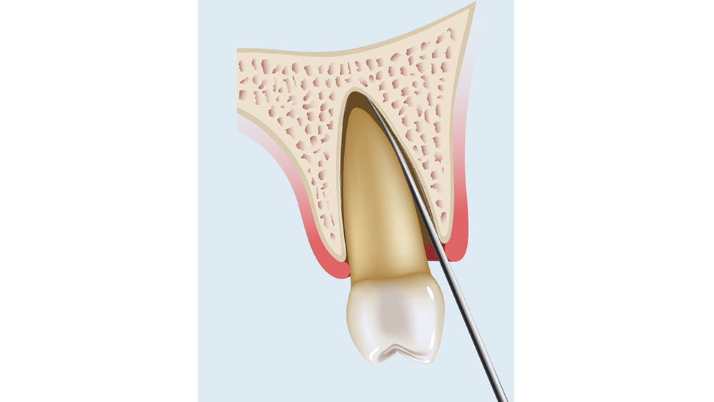 Extraction and Socket Grafting: Part 1 — Atraumatic Extraction
