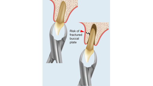 Extraction and Socket Grafting: Part 1 — Atraumatic Extraction